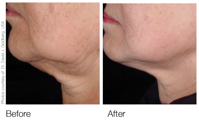 Endymed Pure - Great Look Medical Supplies